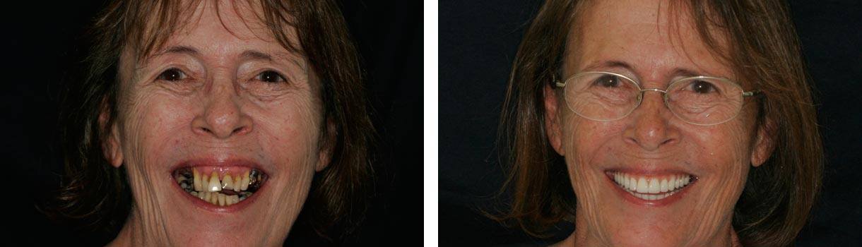 Shannon’s Smile in a Day | TDC Implant Centres
