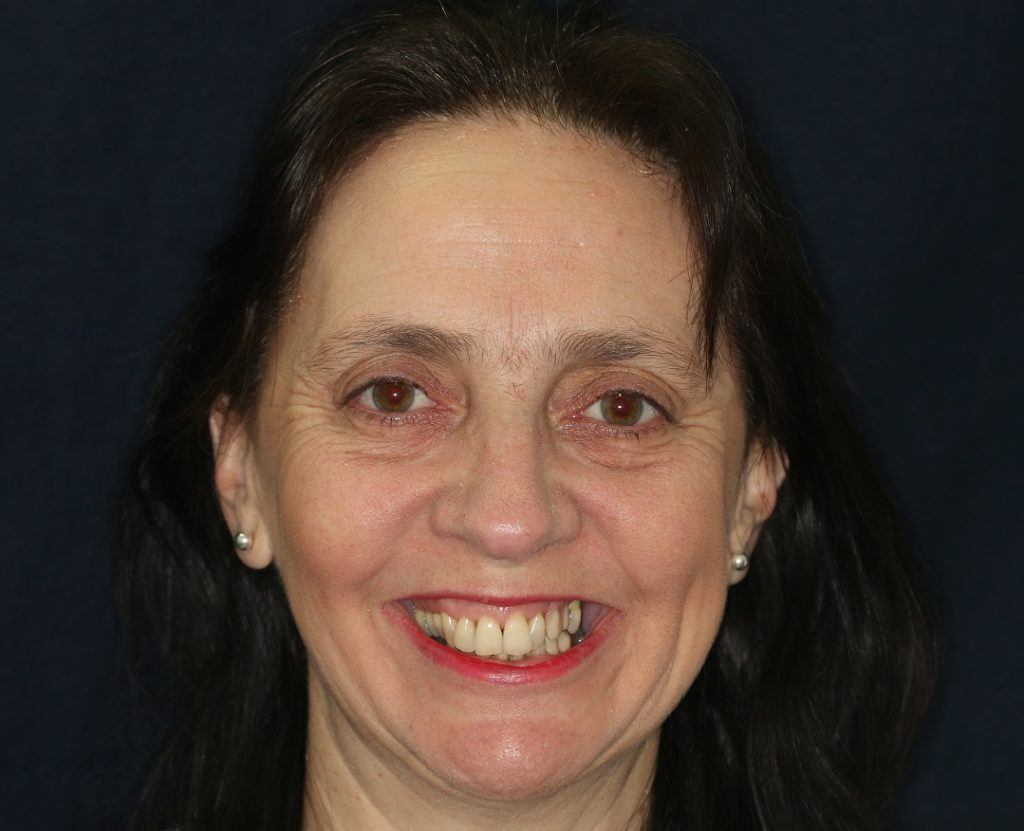 Helen's Smile in a Day | TDC Implant Centres