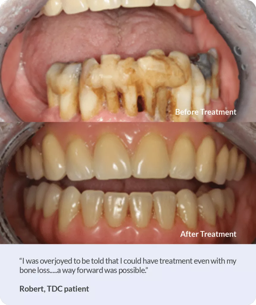 Robert F's Smile in a Day | TDC Implant Centres